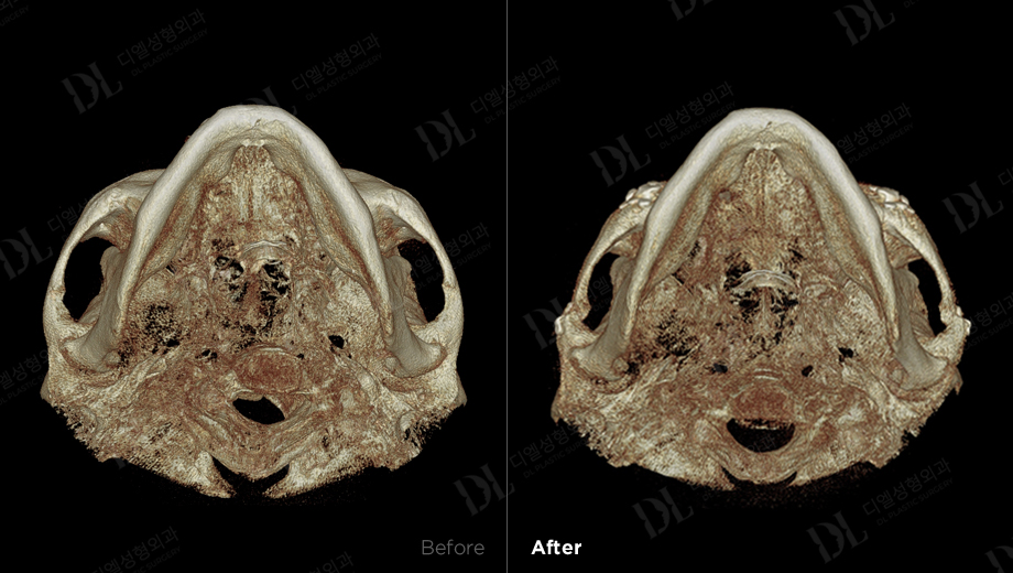 CT Scan Before & After – DL Plastic Surgery