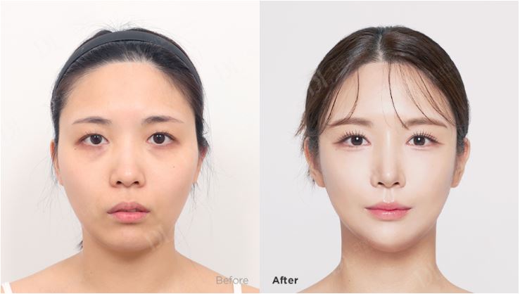 Before & After – DL Plastic Surgery
