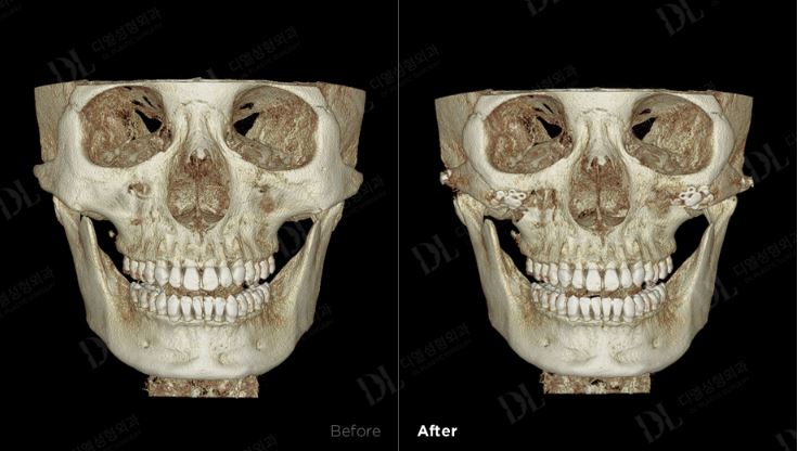 Fitting Cheekbone Reduction – DL Plastic Surgery