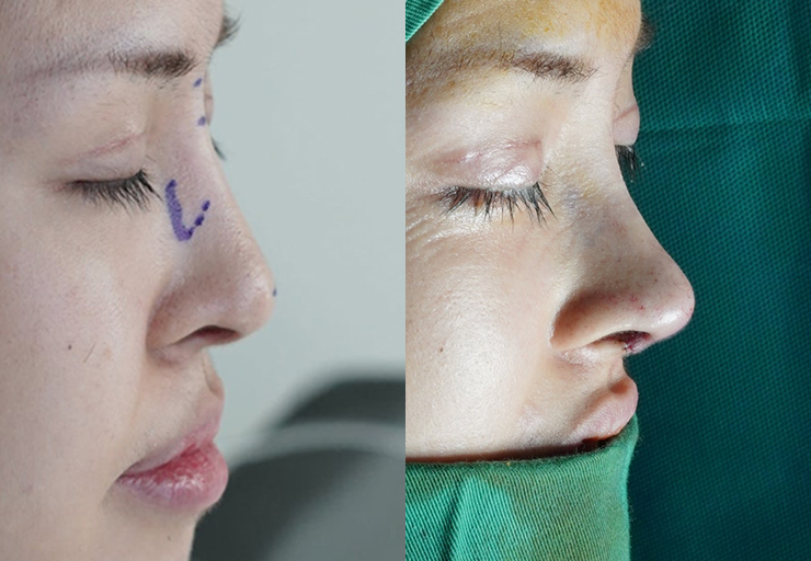 [CASE] Revision Rhinoplasty Using Autologous Rib Cartilage After ...