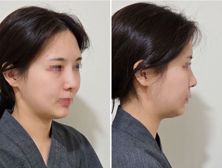 What’s the Most Effective Way to Remove Double Chin Fat? – DL Plastic ...